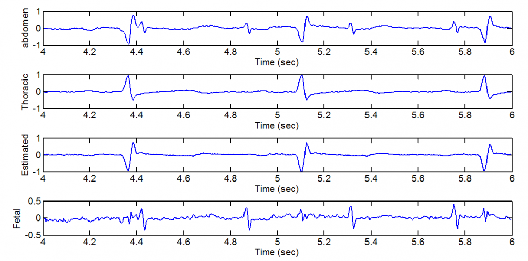 ECG adaptive linear neural network for fetal monitoring ⭐ متلبی